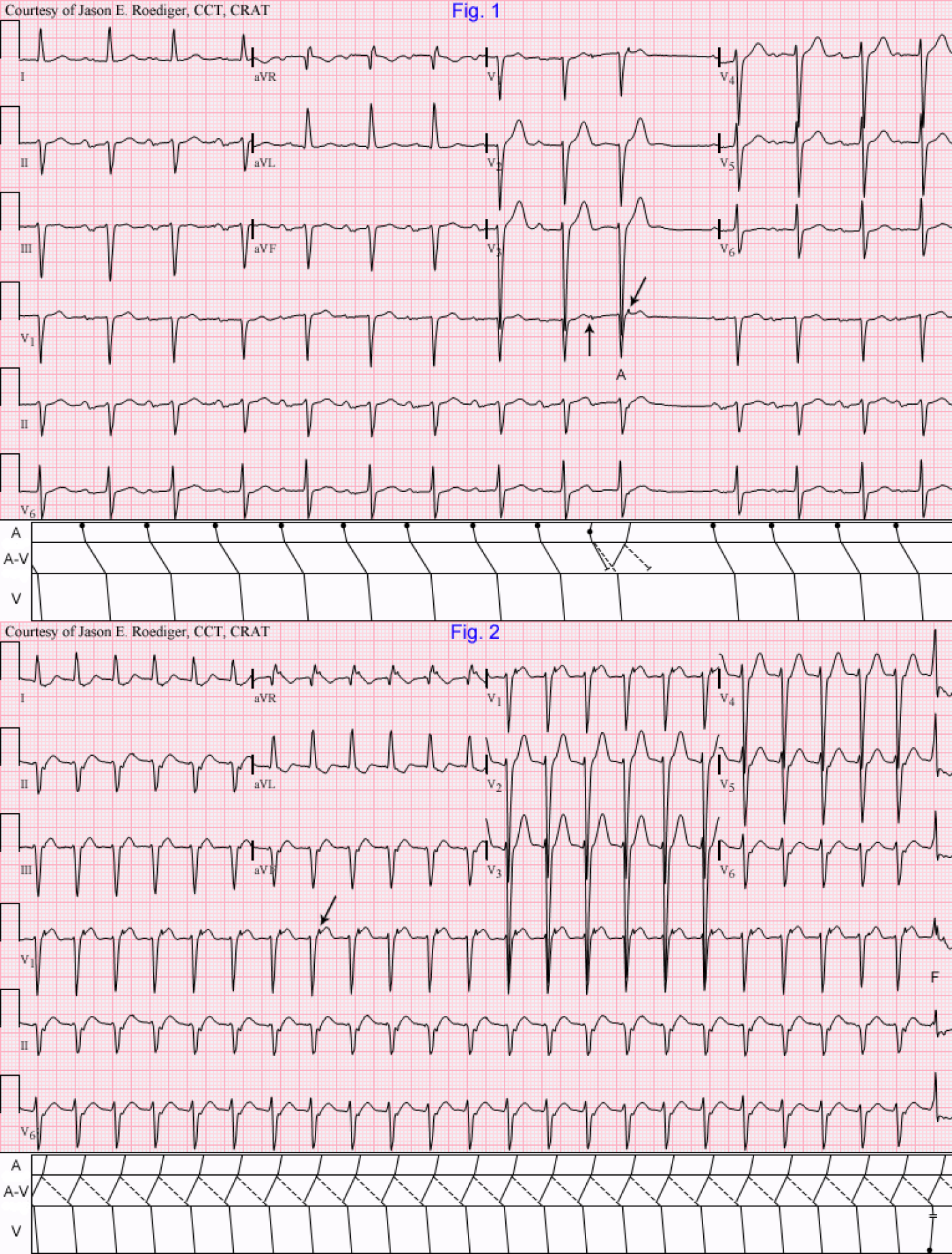 Jasons Blog Ecg Challenge Of The Week For August 19 26 The Value Of
